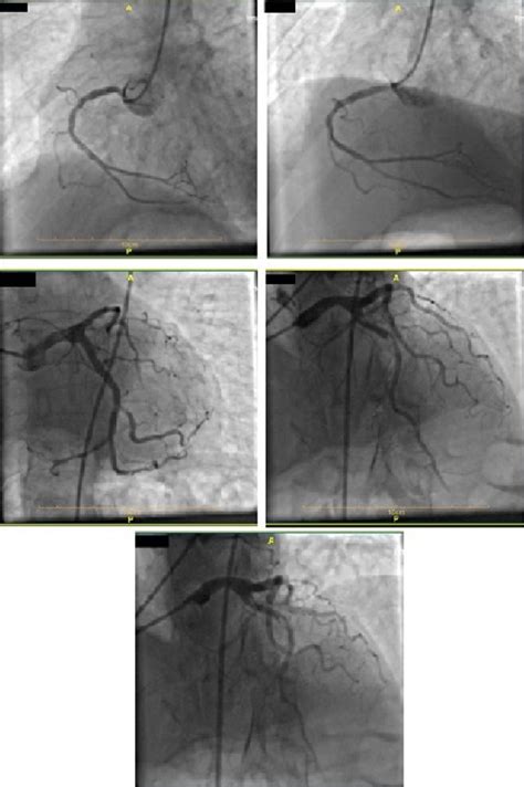 Rca With Severe Intimal Irregularity And Mild Mid Part Stenosis And Download Scientific Diagram