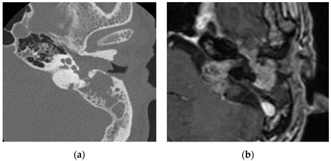 Geniculate Ganglion Mri