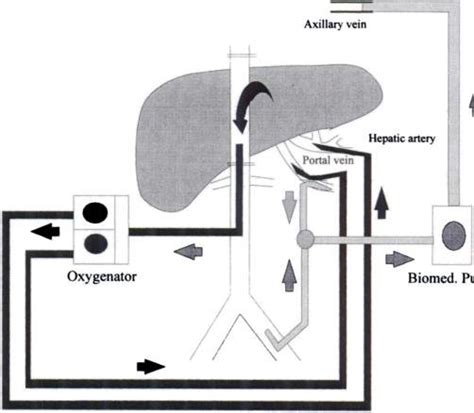 Perfusion Circuit With Extracorporeal Venovenous Bypass Connecting The Download Scientific