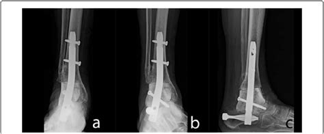 Post Operative Three Month Anterior Posterior A Mortise B And Download Scientific Diagram