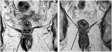 Radiological Findings In Gastrointestinal Scleroderma Pmc