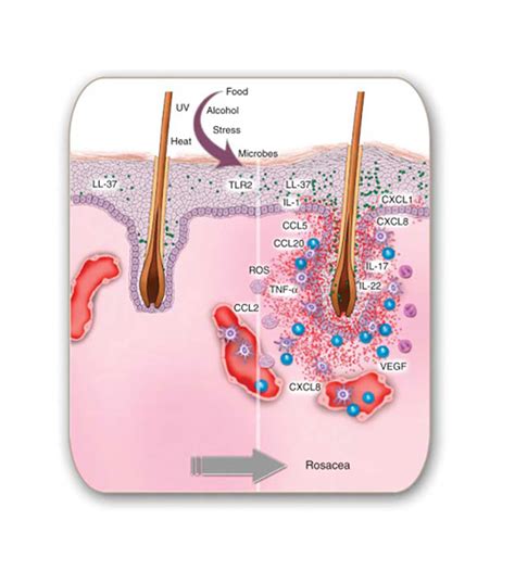 Pyoderma Faciale Rosacea Fulminans