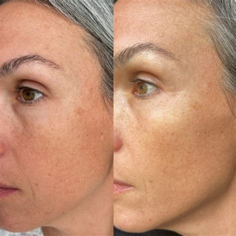 A Beginners Guide To Natural Retinol With Before And After Pics The