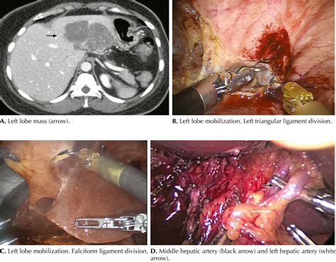 Hepatectomy Clinical Tree