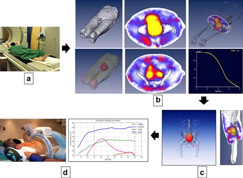 Local Hyperthermia Combined With Radiotherapy And Or Chemotherapy Recent Advances And Promises