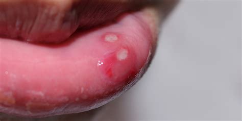 Cold Sores Vs Herpes Std