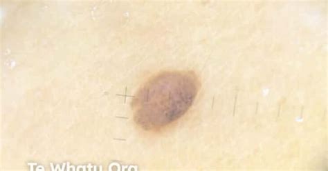 Melanocytic Naevus Image