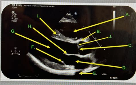 Parasternal Long Axis Diagram Quizlet