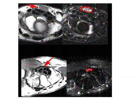 Soft Tissue Swelling Ppt