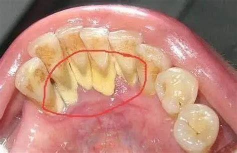 牙齿上黄黄的一层，是牙垢还是牙结石？牙医教你一招区分 知乎