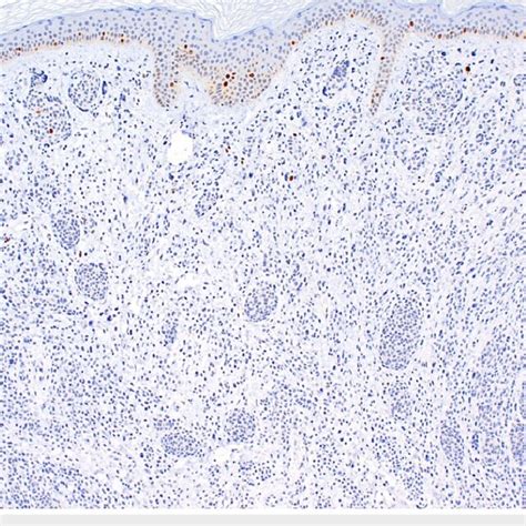 Immunohistochemical Staining For Ki67 Within The Expansile Zone Ki67 Download Scientific
