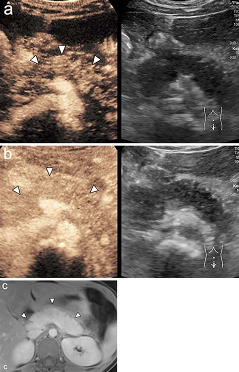 Interstitial Pancreatitis In A 7 Year Old Girl Who Presented With Acute