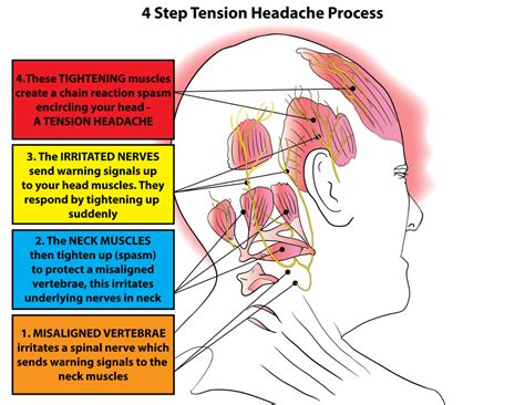 Trigger Point Therapy Tension Type Headaches Tth Niel Asher