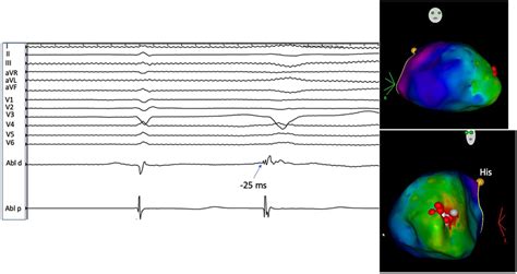 Electrogram At The Site Of Initial Ablation Was 25 Ms Presystolic Left Download Scientific