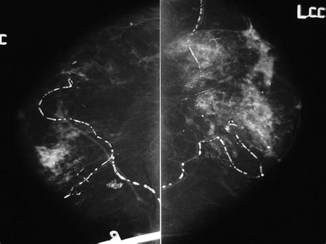 B 57 Year Old Female With Breast Calcifications Cc Images From The Download Scientific