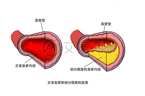 正常血管和部分阻塞的血管示意图医疗图片素材高清图片素材