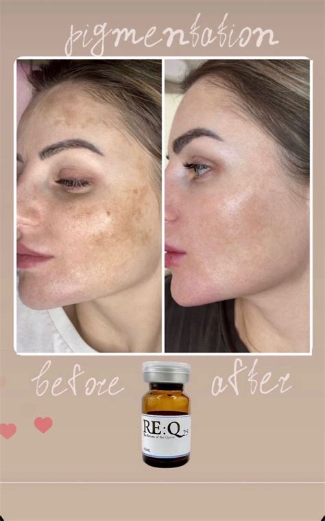 Req Is A Stem Cell Cultured Broth That Contains Over 130 Growth Factor