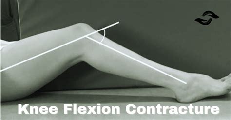 Knee Flexion Contracture Causes And Exercises Physio Health And Wellness