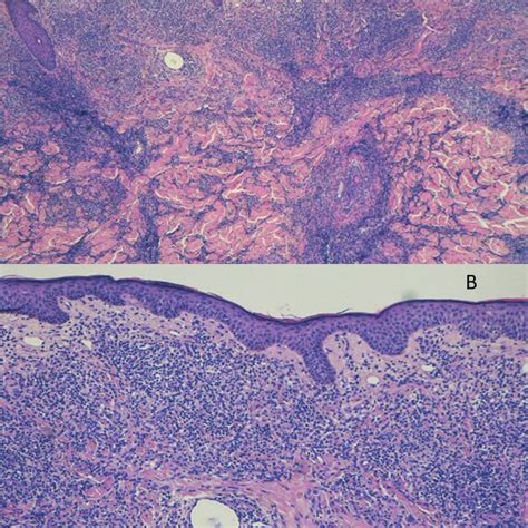 A Dense Diffuse And Angiocentric Mononuclear Cell Infiltrate Download Scientific Diagram