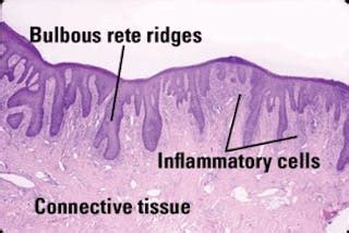 Median Rhomboid Glossitis Registered Dental Hygienists