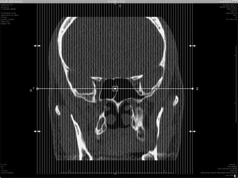 Its Elemental Sagittal Ct Scan Slices