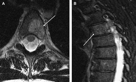 Comprehensive Management Of Symptomatic And Aggressive Vertebral