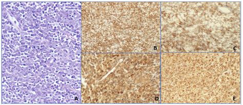 Transurethral Resection Pathology Bladder Granulocytic Sarcoma A Download Scientific Diagram