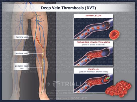 Deep Vein Thrombosis Dvt Trialquest Inc