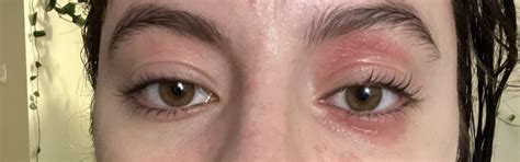 1 Best U14onthephscale Images On Pholder Psoriasis Around Eye