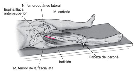 Artroplastia Total De Cadera Mediante Un Abordaje Anterior Directo