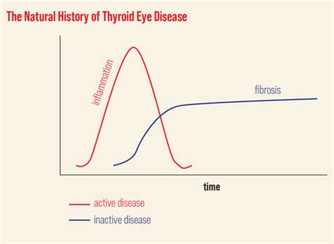 Lesson What Ods Need To Know About Thyroid Eye Disease