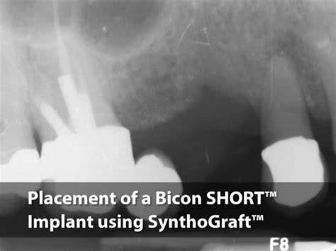 Guided Bone Regeneration Bicon Dental Implants