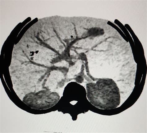Nitin Negi On Linkedin Ct Portography Portal Enhancement With Superior Mesentric Artery