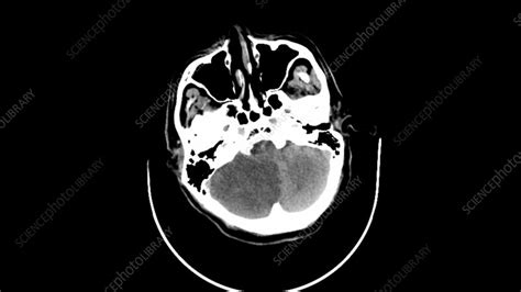 Stroke Ct Scan Stock Image F0436781 Science Photo Library Stroke Ct Scan Stock Image F0436781 Science Photo Library