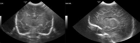 Sagittal Cranial Ultrasound Head Ultrasound Meaning Fqtty