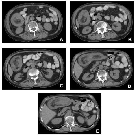 Ileocecal Intussusception Showing In A Way Of Sequencing The