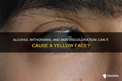 Alcohol Withdrawal And Skin Discoloration Can It Cause A Yellow Face