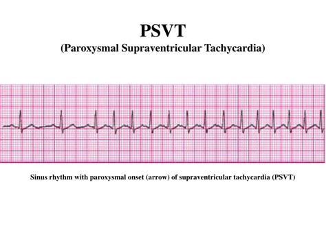 Difference Between Nsvt And Vt At Lester Mitchell Blog