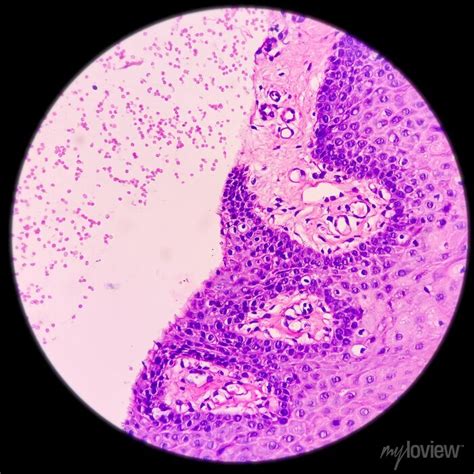Buccal Mucosa Squamous Hyperplasia Show Hyperplastic Squamous Posters For The Wall • Posters