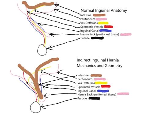 Sliding Type Inguinal Hernia At John Dumas Blog