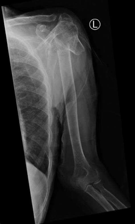 Radiograph Of The Left Humerus Demonstrates An Acute Transverse Download Scientific Diagram