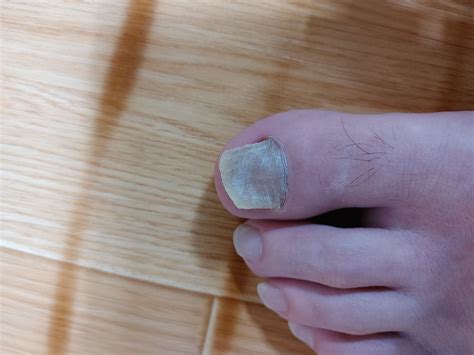 발톱무좀 없애는 방법 최신