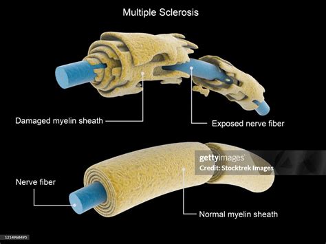 Multiple Sclerosis Neuron Compared To A Normal Neuron High Res Vector