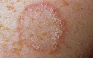 Our Parkinson S Place Common Skin Wound Challenges Encountered In Parkinsons Disease By Dr
