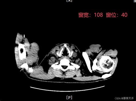 dicom医学影像应用篇——窗宽窗位概念、原理及实现详解 骨窗 csdn博客