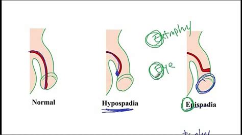 Usmle Ace Video 255 Congenital Urethral Anomalies Epispadias And