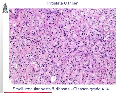 Pathology Of Prostate
