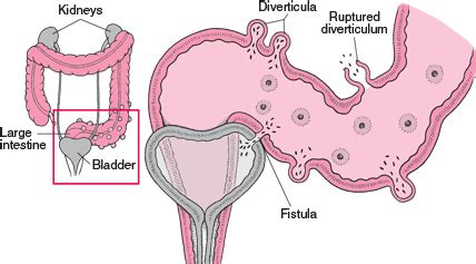 Bladder Diverticular Wall Urinary Bladder Diverticulum Treatment Uieb