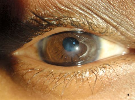 Keratoconus Histology