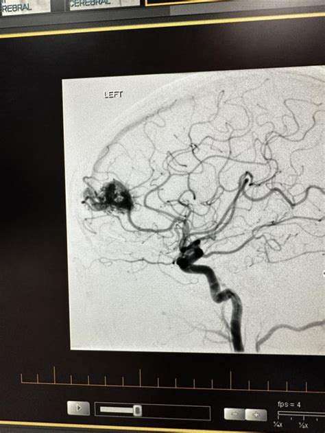 AVM surgery : r/AVMs